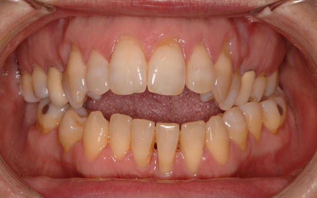Mordida abierta anterior - Clínica Dental Larrañaga