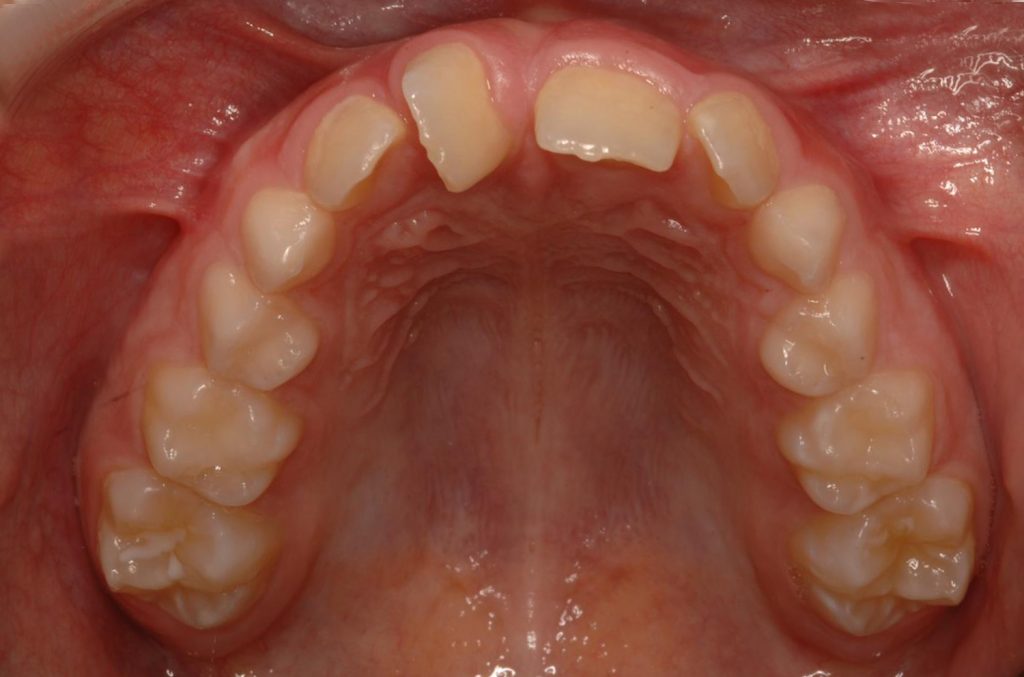 Dientes supernumerarios - Clínica Dental Larrañaga