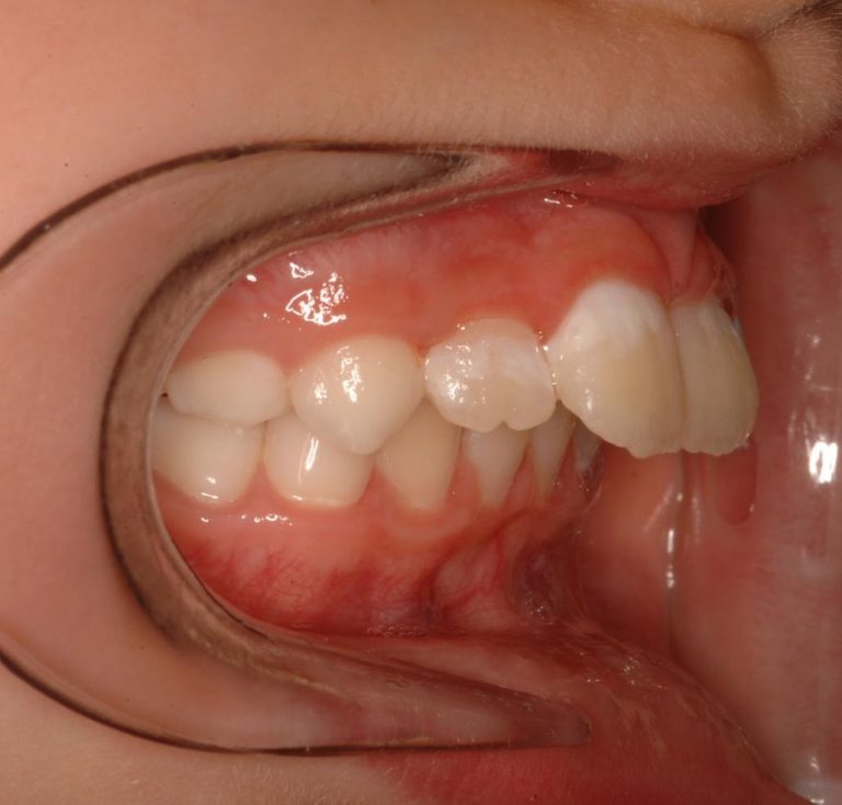 Clase II - Maloclusiones en ortodoncia - Clinica Dental Larrañaga