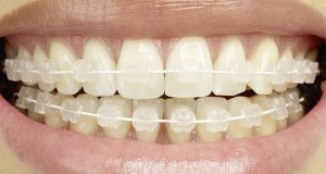 Sistemas y tipos de Brackets - Clínica Dental Larrañaga