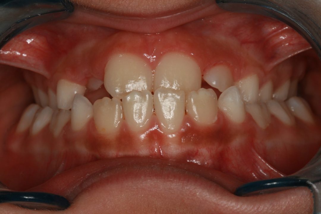 Clase III - Maloclusiones en Ortodoncia - Clínica Dental Larrañaga