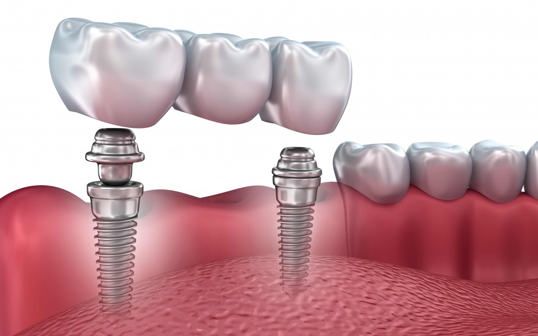 Prótesis sobre implantes - clínica dental Larrañaga