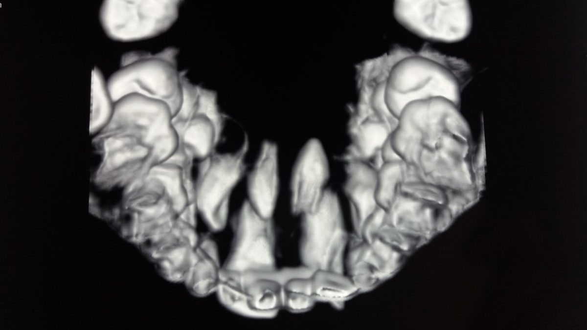Dientes supernumerarios - Clínica Dental Larrañaga